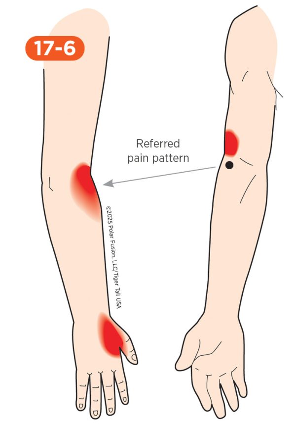 Supinator Pain & Trigger Points | Tiger Tail USA
